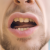What Does A Swollen Uvula Mean – San Diego Health