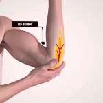 Top 7 Causes of Upper Arm Weakness: How to Treat It: – San Diego Health