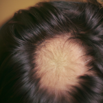 4 Hard Bump on the Scalp Causes – San Diego Health